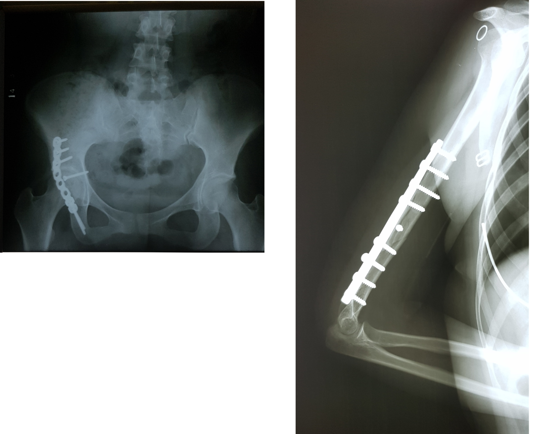 FRACTURA DE ACETABUL O DERY HÚMERO IZQUIERDO – Dr Oscar Pereyra